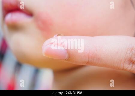 mother applying topical antihistamine cream at kid face with skin rash ...