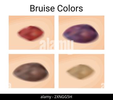 Healing Stages of Bruises and Hematomas Stock Vector Image & Art - Alamy