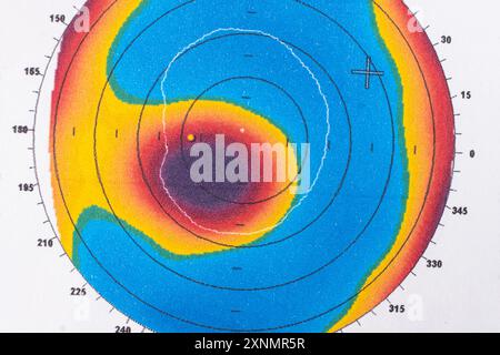 Results of the examination of the thickness and curvature of the cornea ...