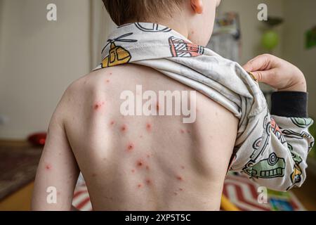 Chickenpox disease infection outbreak care, prevention and protection ...