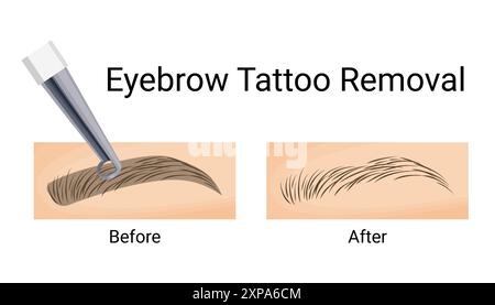 Eyebrow Tattoo Removal Before And After Results Vector Illustration
