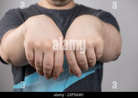 Comparison of healthy arm and arm with wrist ganglion cyst Stock Photo ...
