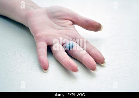 Consequence of removing warts on the hand with liquid nitrogen. Burn ...