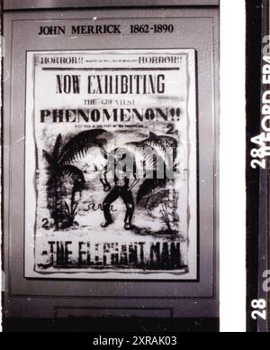 Joseph 'John' Carey Merrick (1862-90) - aka The Elephant Man. Pathology ...