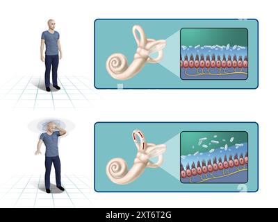 Benign paroxysmal positional vertigo. Vertigo caused by inner ear ...