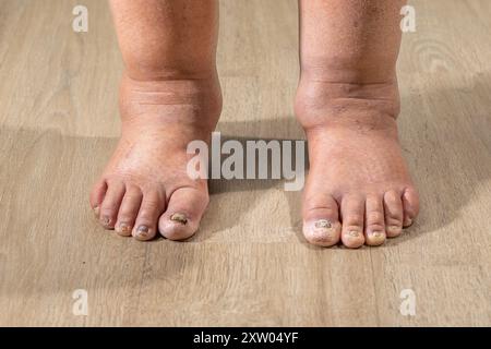 Cancer chemotherapy cause swelling of ankles (ankle oedema) , skin to ...