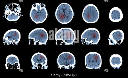 Brain abscess, CT scan Stock Photo - Alamy