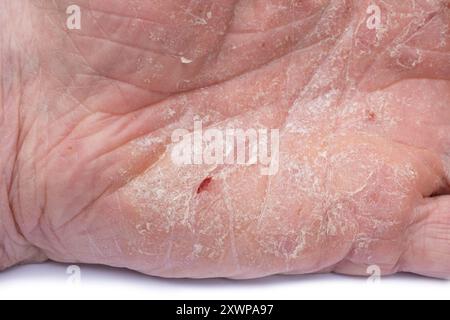 Hand eczema. Lesions, hemorrhages, cracks, crusts, flaking, hyperkeratotic plaques, fissures due ...