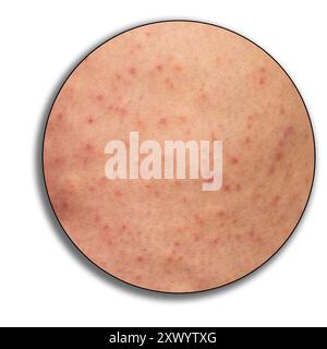 close-up of woman's legs with keratosis pilarar, an acute folliculitis ...