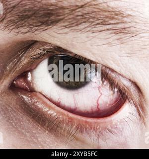 Medicine healthcare blood capillary human eye pain Stock Photo - Alamy