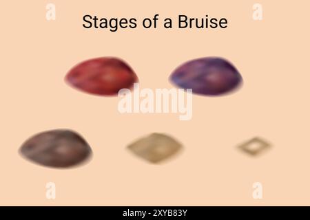 Healing Stages of Bruises and Hematomas Stock Vector Image & Art - Alamy
