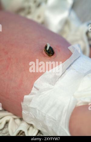 An infants umbilical cord stump is carefully cleaned with a cotton swab ...