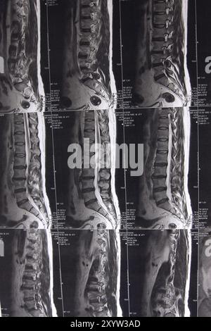 Slipped disc. Magnetic resonance imaging (MRI) scan of an axial ...
