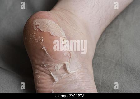 Skin peeling off a foot Stock Photo - Alamy