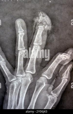 Plain X-Ray reveals distal tip amputation of distal phalanx of the ...