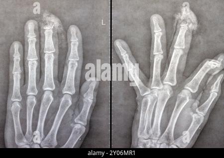 Plain X-Ray reveals distal tip amputation of distal phalanx of the ...