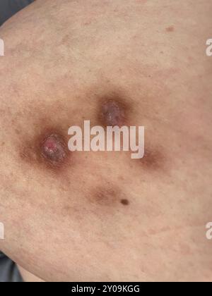 Entzündliche Veränderungen Pusteln, Ausschlag auf der Haut Stock Photo ...