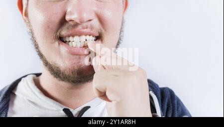 Close up of man with dermatophagia, biting his nails. Person biting ...
