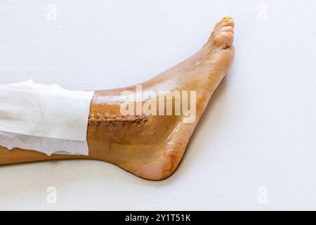 Right leg after surgery to repair a dislocated ankle joint and connect ...