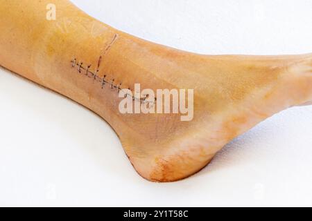 Right leg surgery, dislocated ankle, broken foot bone, stitches ...