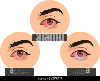 Conjunctivitis - Excessive Sticky Discharge from Human Eye - Stock ...