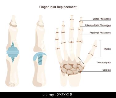 Joint implantation. Injured or distracted human joint replaced with ...