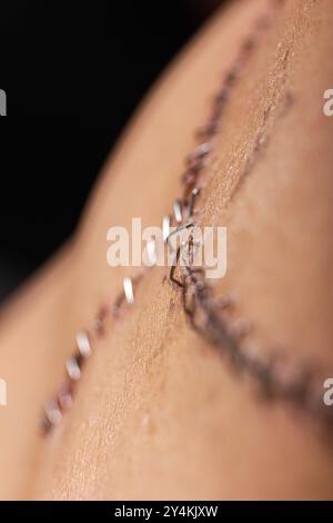 Closeup of medical staples helping a surgical incision and scar heal ...