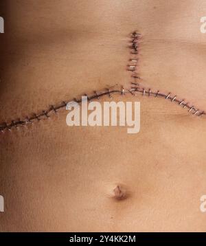 Closeup of medical staples helping a surgical incision and scar heal ...