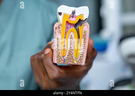 Dental model illustrating tooth decay on the exterior surface and a ...