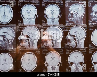 MRI of the human brain of a patient with multiple sclerosis of the ...