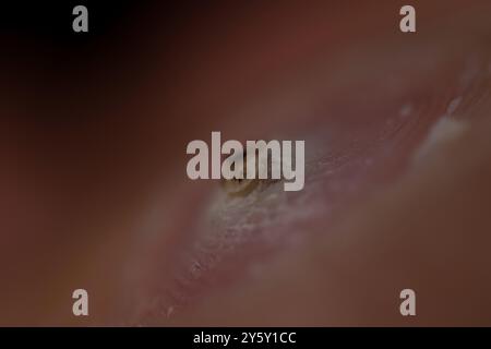 Plantar wart close up hpv infection skin disease Stock Photo - Alamy