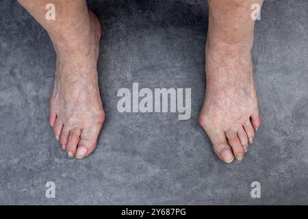 An old woman's foot with untrimmed nails and a painful, enlarged big ...