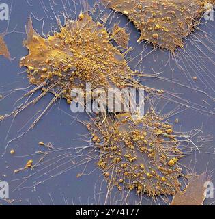 Bone cancer cell. Scanning electron micrograph of an osteosarcoma ...