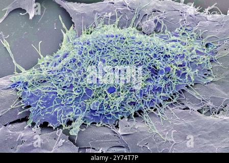 Bone cancer cell. Scanning electron micrograph of an osteosarcoma ...