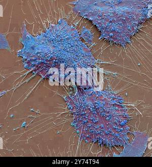 Bone cancer cell. Scanning electron micrograph of an osteosarcoma ...