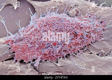 Bone cancer cell. Scanning electron micrograph of an osteosarcoma ...