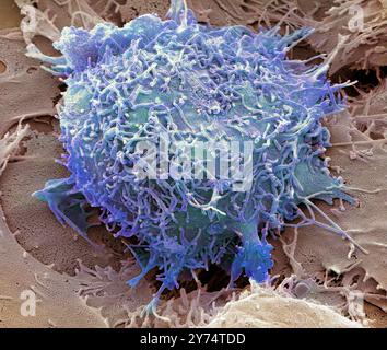 Liver cancer cell. Coloured scanning electron micrograph (SEM) of a ...