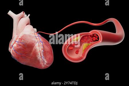 atherosclerosis coronary disease with plaque build up in the arteries ...