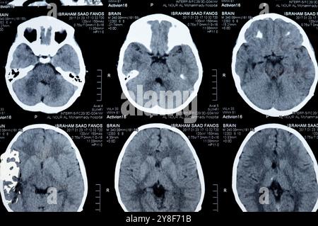 Cairo, Egypt, September 17 2024: Brain CT scan reveals left shunt tube ...