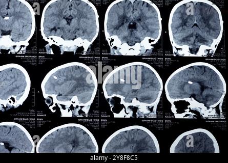 Cairo, Egypt, September 17 2024: Brain CT scan reveals left shunt tube ...