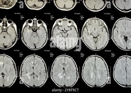 MRI of the brain reveals previous shunt operations for a hydrocephalus ...