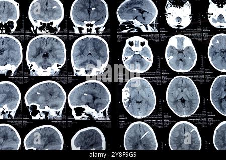 Cairo, Egypt, September 17 2024: Brain CT scan reveals left shunt tube ...