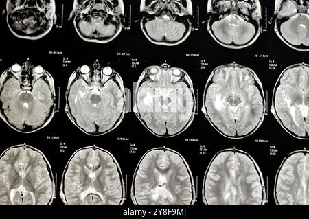 MRI of the brain reveals previous shunt operations for a hydrocephalus ...
