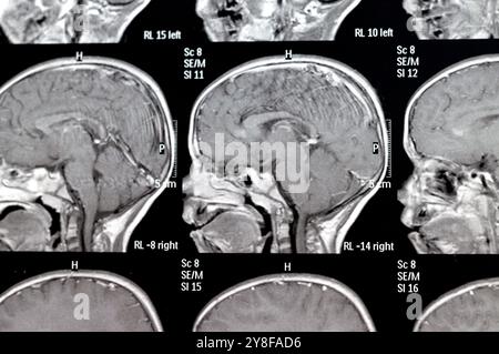 MRI of the brain reveals previous shunt operations for a hydrocephalus ...