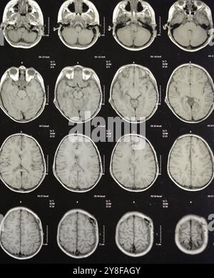 MRI of the brain reveals previous shunt operations for a hydrocephalus ...