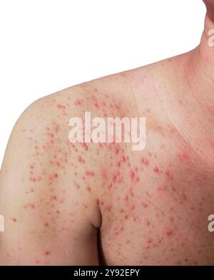 Painful rash red spots blisters on child leg Stock Photo - Alamy