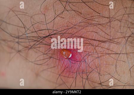Macro shot of inflamed skin pore with hair follicles and a small pus ...