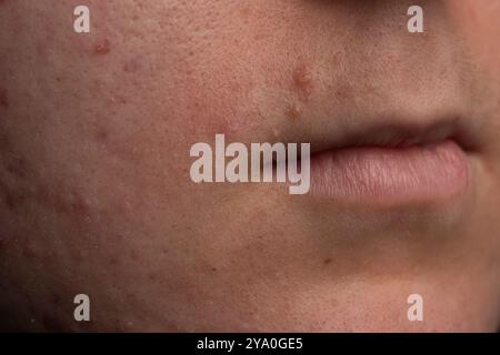 Skin health problem, skin diseases. Skin acne background. Closeup acne ...
