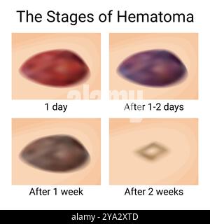 Healing Stages of Bruises and Hematomas Stock Vector Image & Art - Alamy