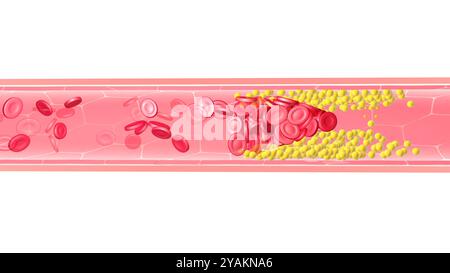 3d illustration of the anatomical interior of an artery. Obstructed by ...